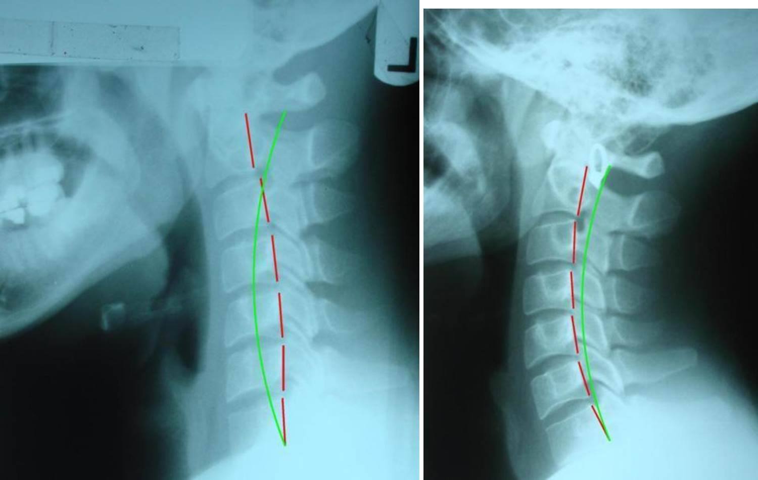 Cervical Denneroll | HealthStar Clinic